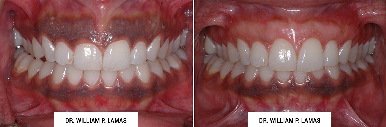 Dark Gum Depigmentation Before & After Photos - Dr. William Lamas