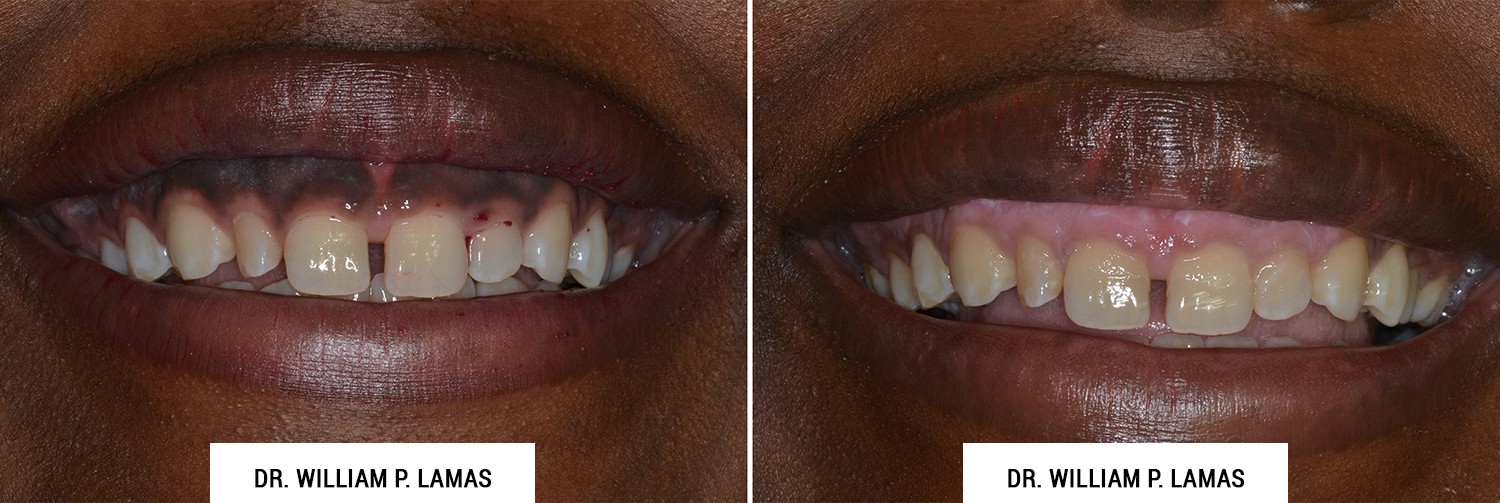 Dark Gum Depigmentation Before & After Photos - Dr. William Lamas